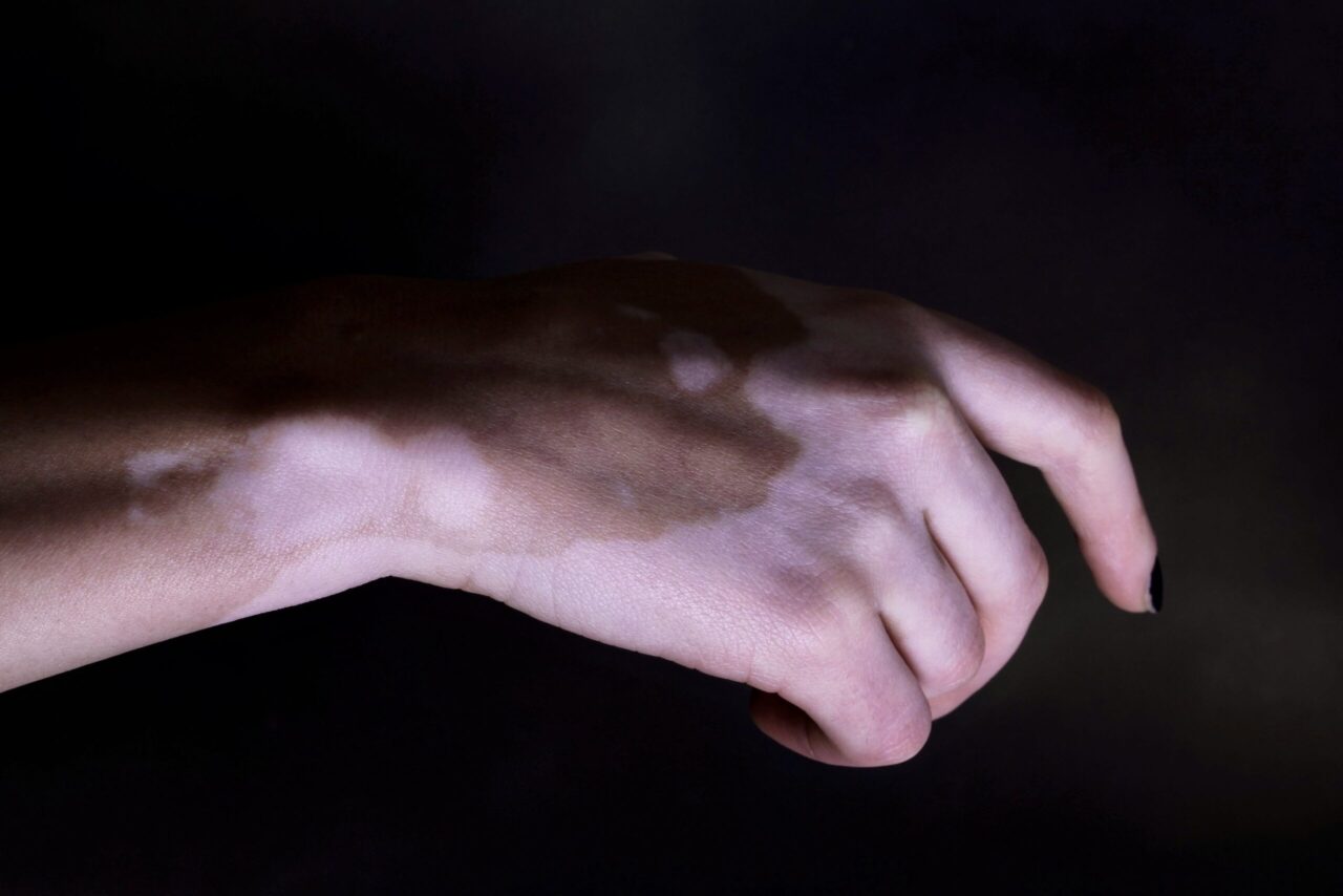 Λεύκη: Προλαμβάνεται η εποχική έξαρση των συμπτωμάτων; - The Opinion